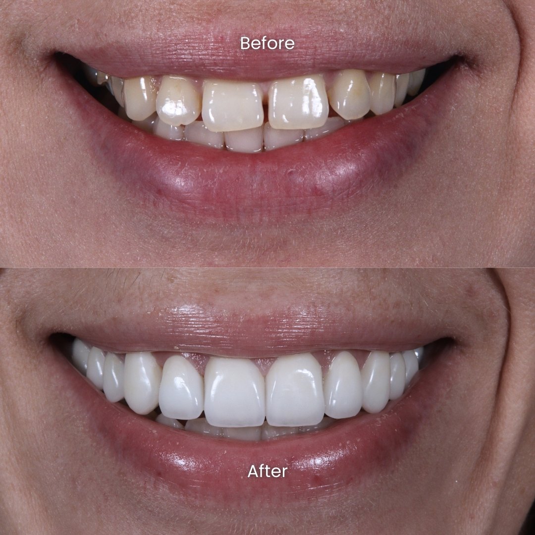 Before & After Dental Implants, Veneers & Smile Transformations
